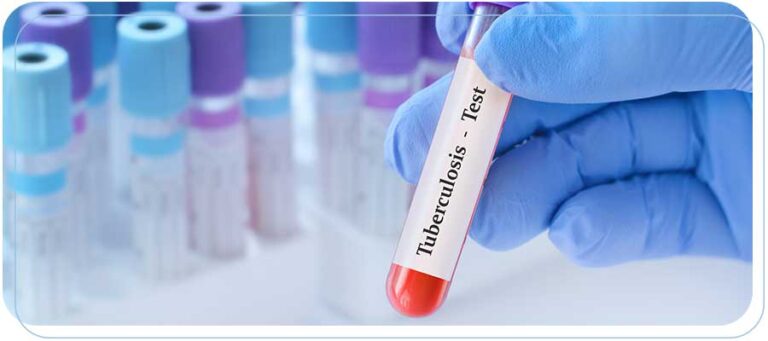 What Is a TB (Tuberculosis) Test? | Reddy Urgent Care